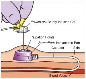 Portocaths - Cairns Vascular Clinic